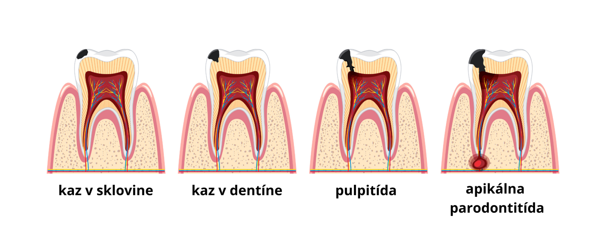 Zápal zuba: Najčastejšie príčiny, príznaky a možnosti liečby » Ortho ...